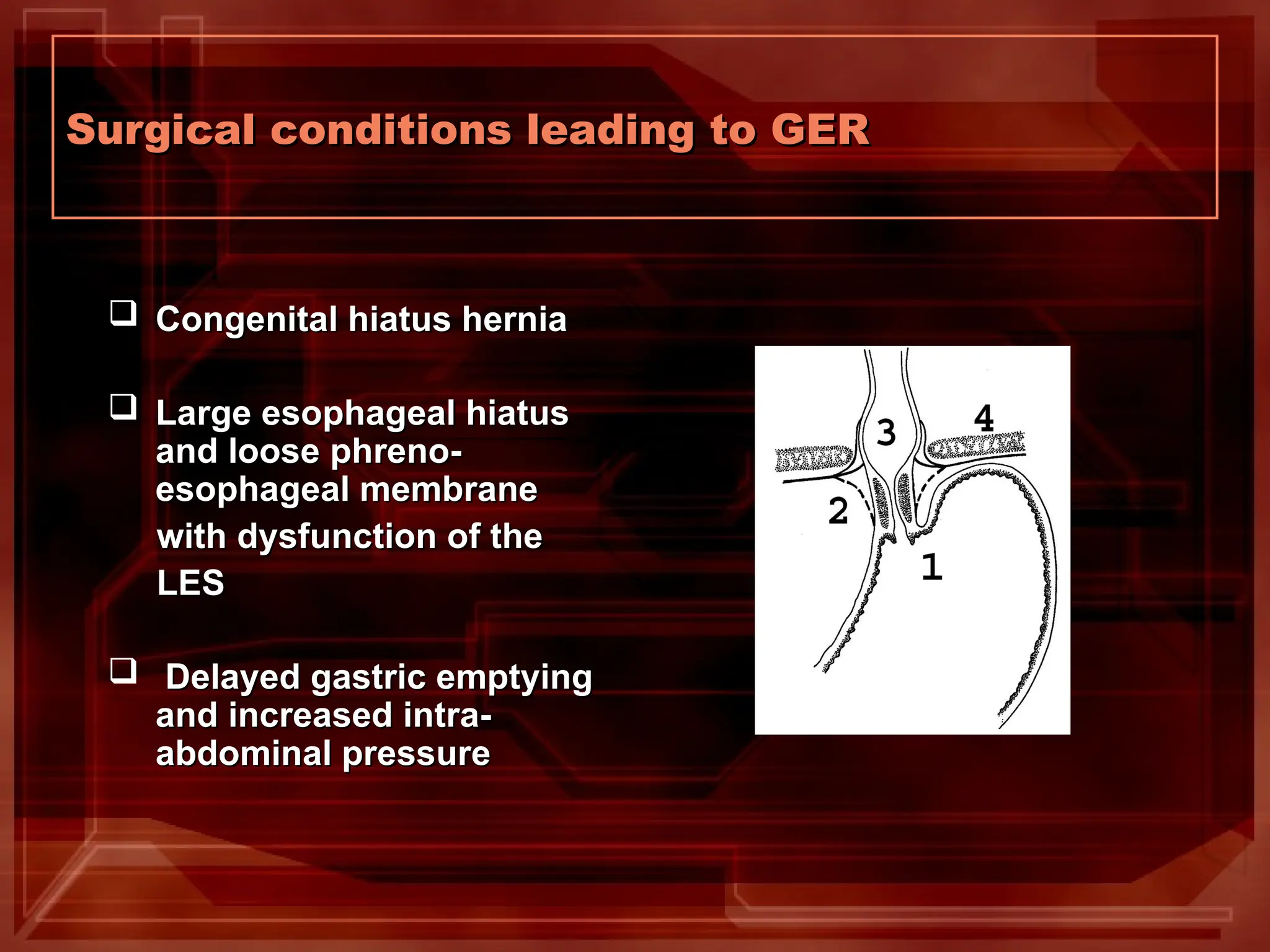 Surgical aspects in GERD in children.ppt
