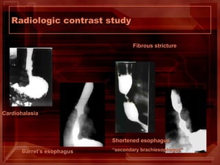 Surgical aspects in GERD in children.ppt