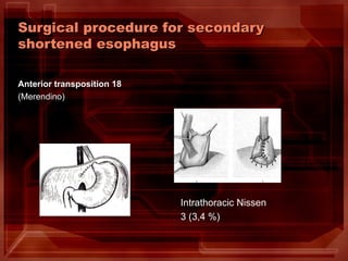 Surgical aspects in GERD in children.ppt