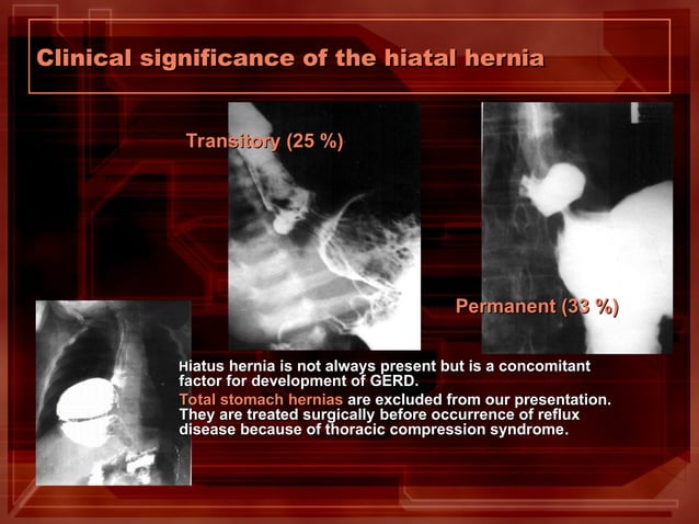 Surgical aspects in GERD in children.ppt