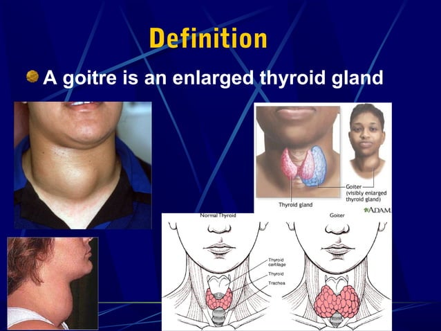 Surgical aspects of goitre | PPT