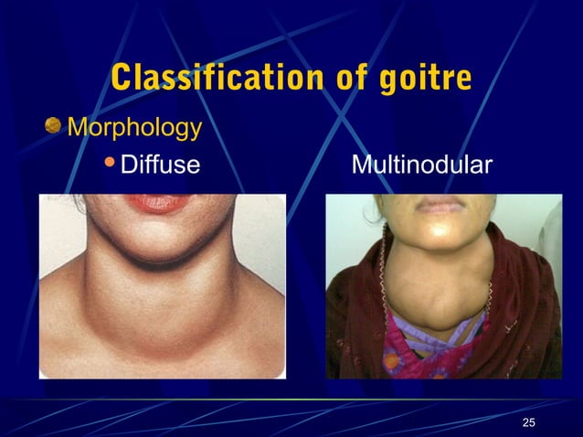 Surgical aspects of goitre | PPT
