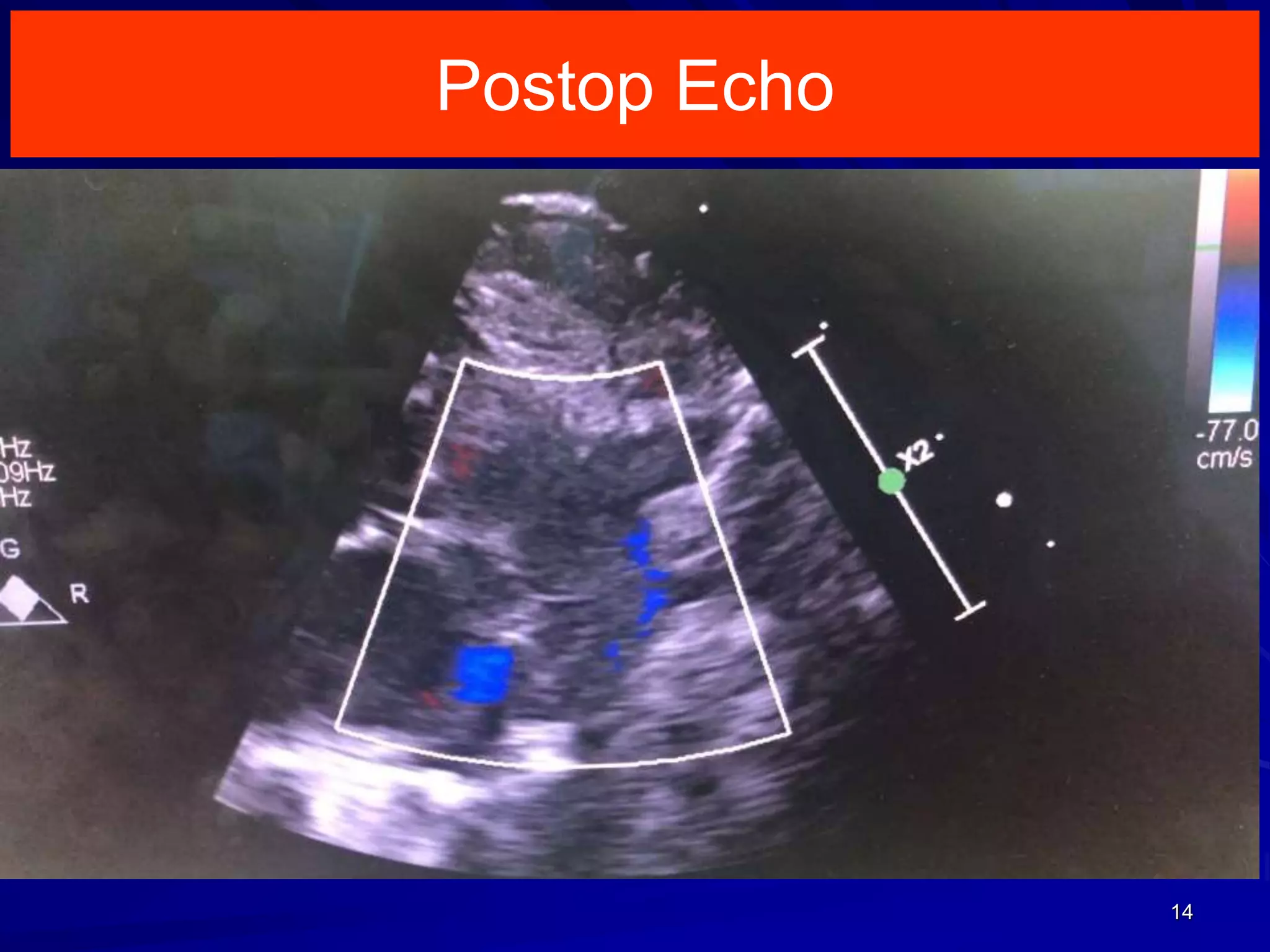 Surgical closure Neonatal PDA | PPTX