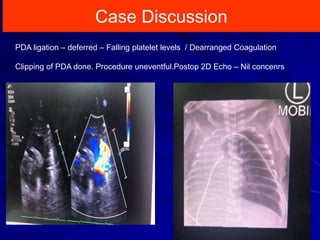 Surgical closure Neonatal PDA | PPTX | Heart and Cardiovascular ...