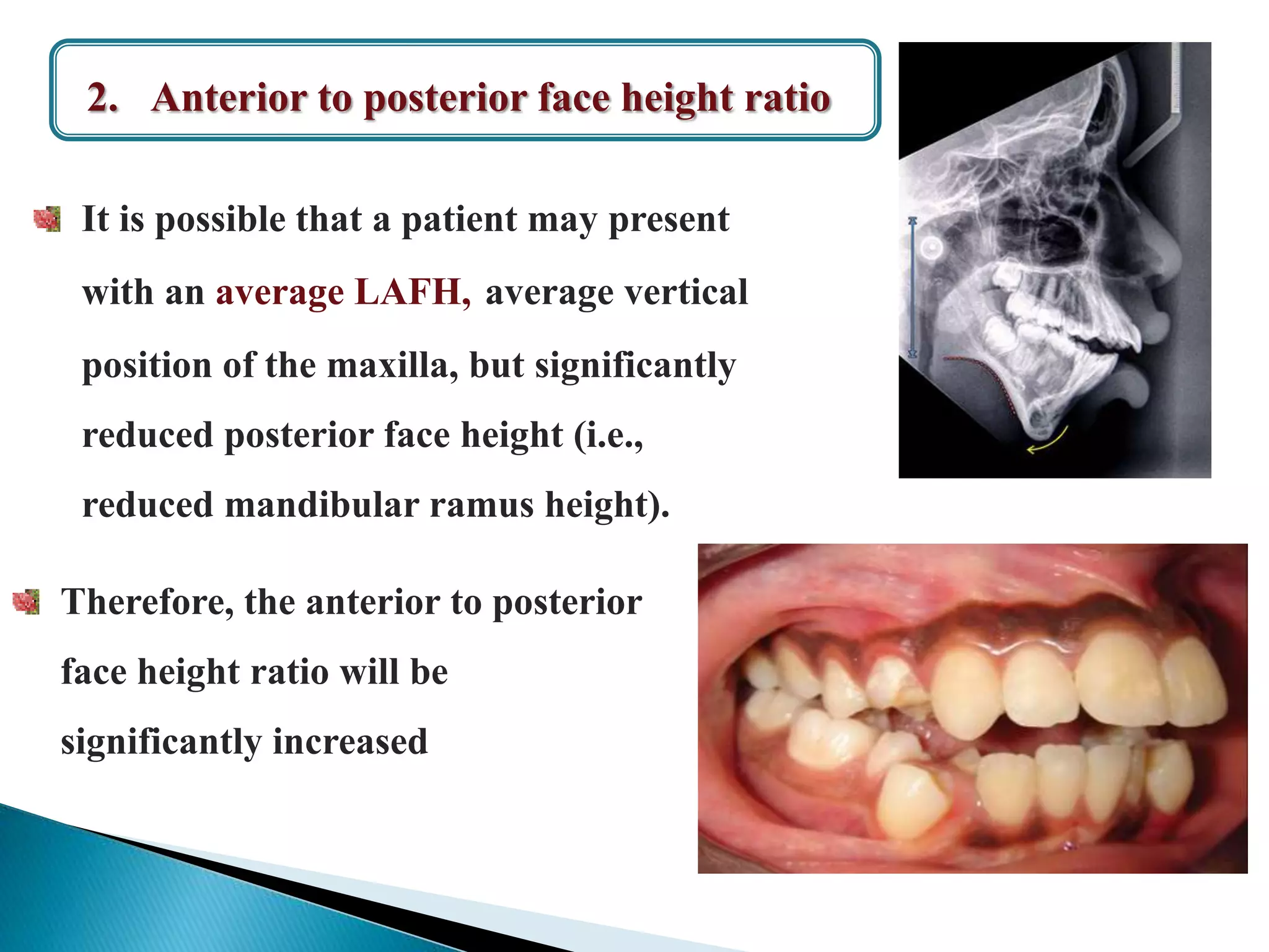 Surgical correction of anterior openbite | PPTX