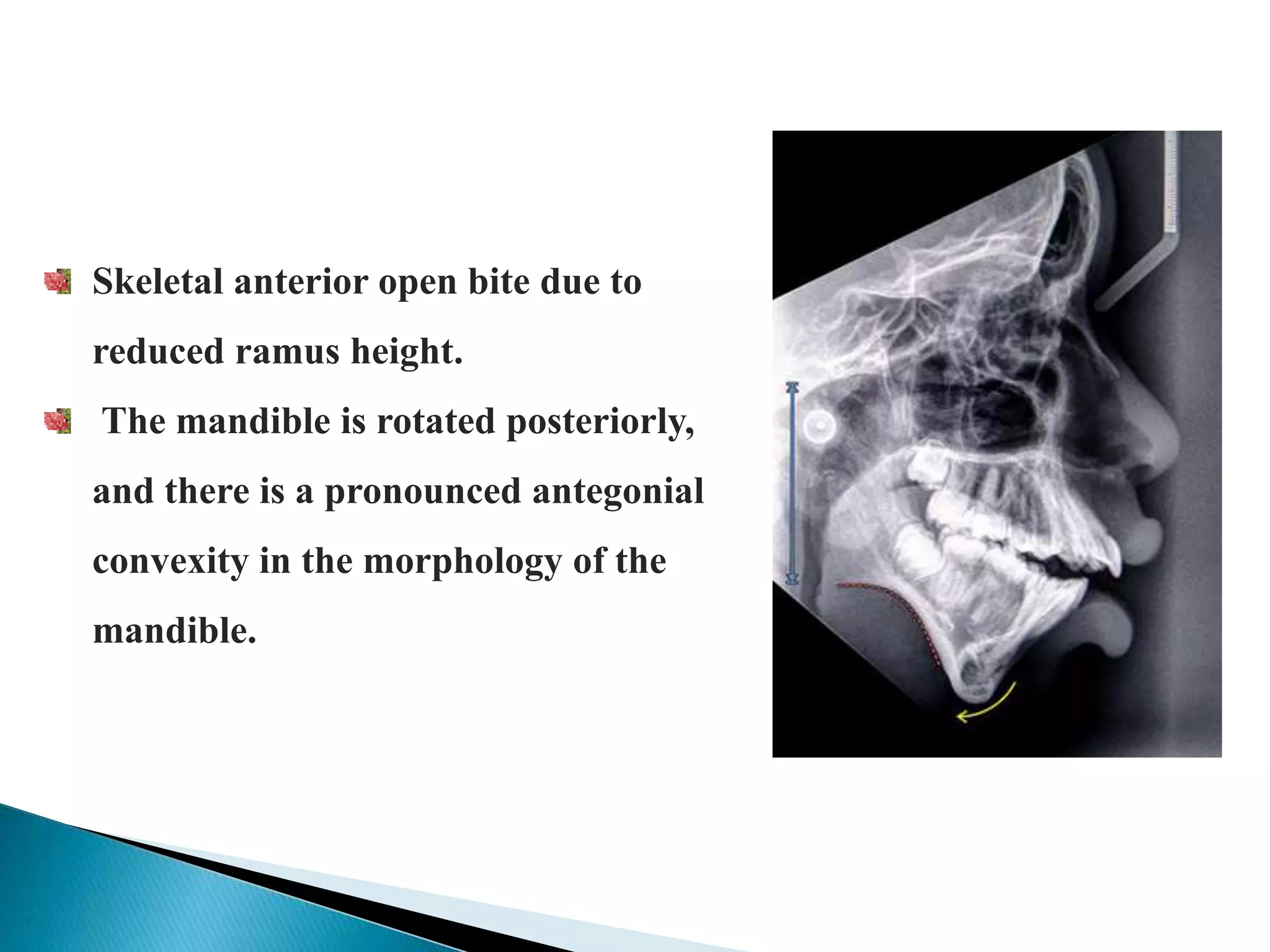 Surgical correction of anterior openbite | PPTX