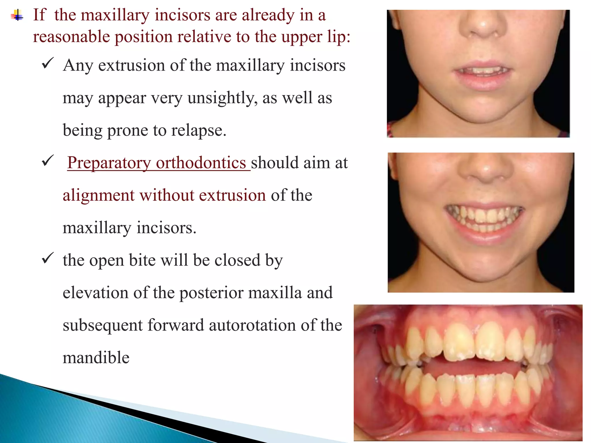 Surgical correction of anterior openbite | PPTX