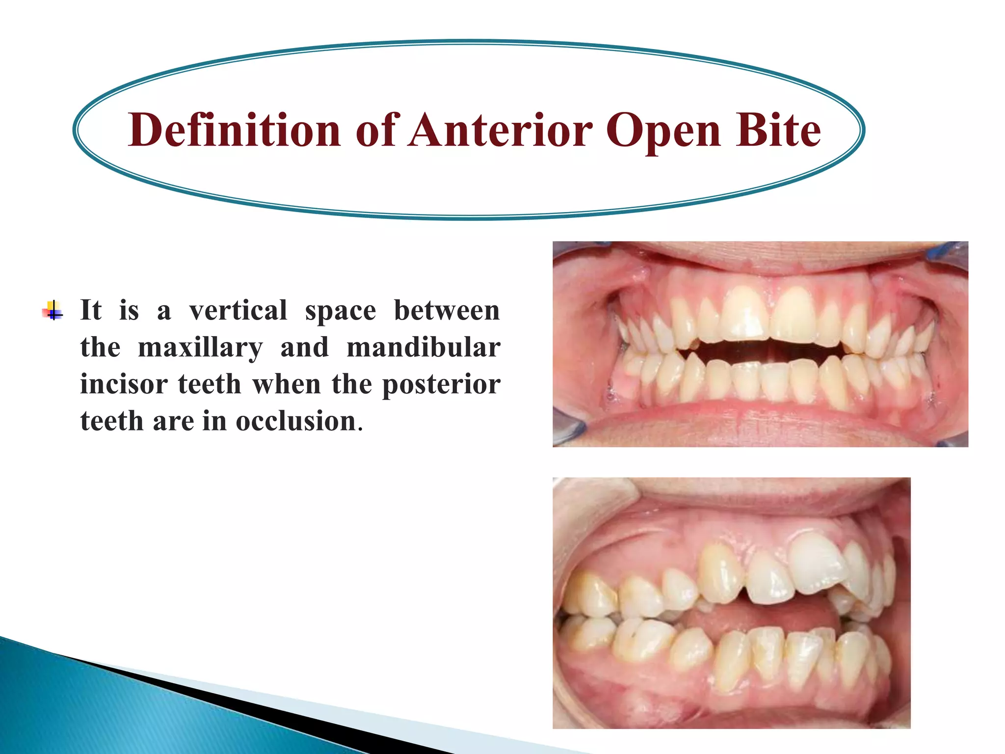 Surgical correction of anterior openbite | PPTX