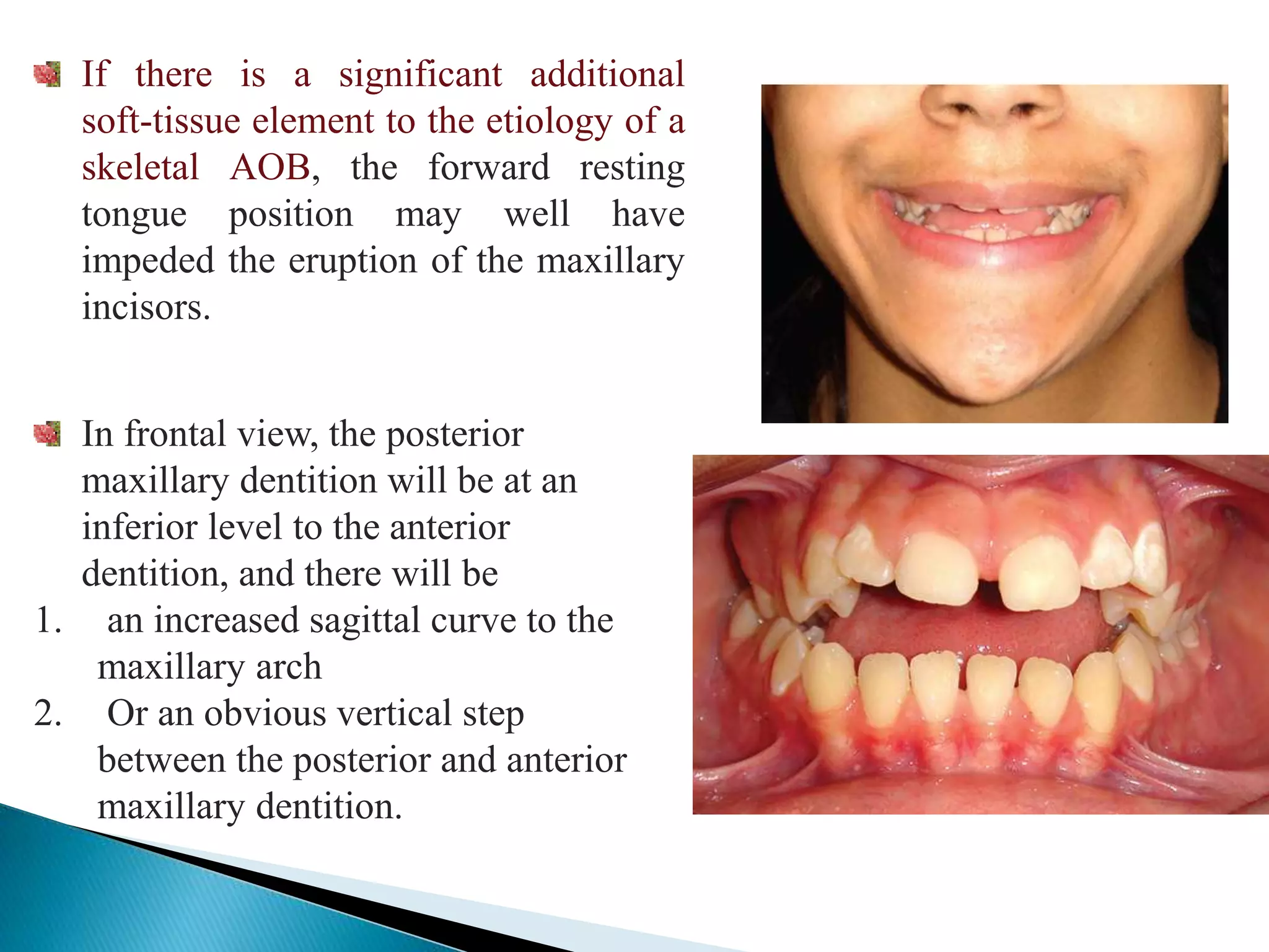 Surgical correction of anterior openbite | PPTX