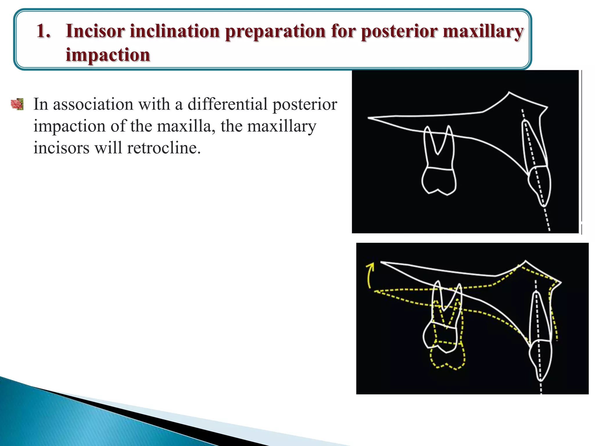 Surgical correction of anterior openbite | PPTX