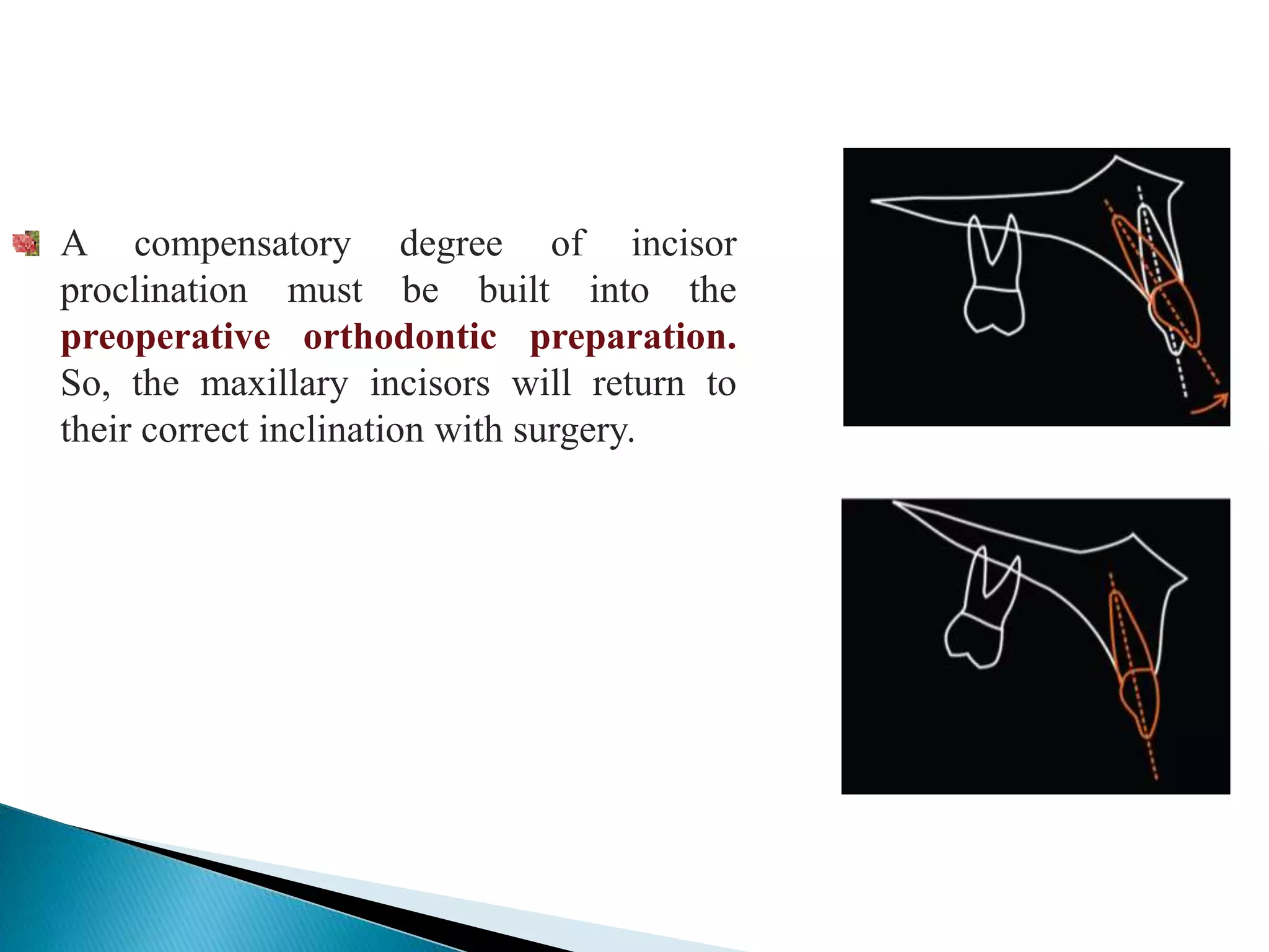 Surgical correction of anterior openbite | PPTX