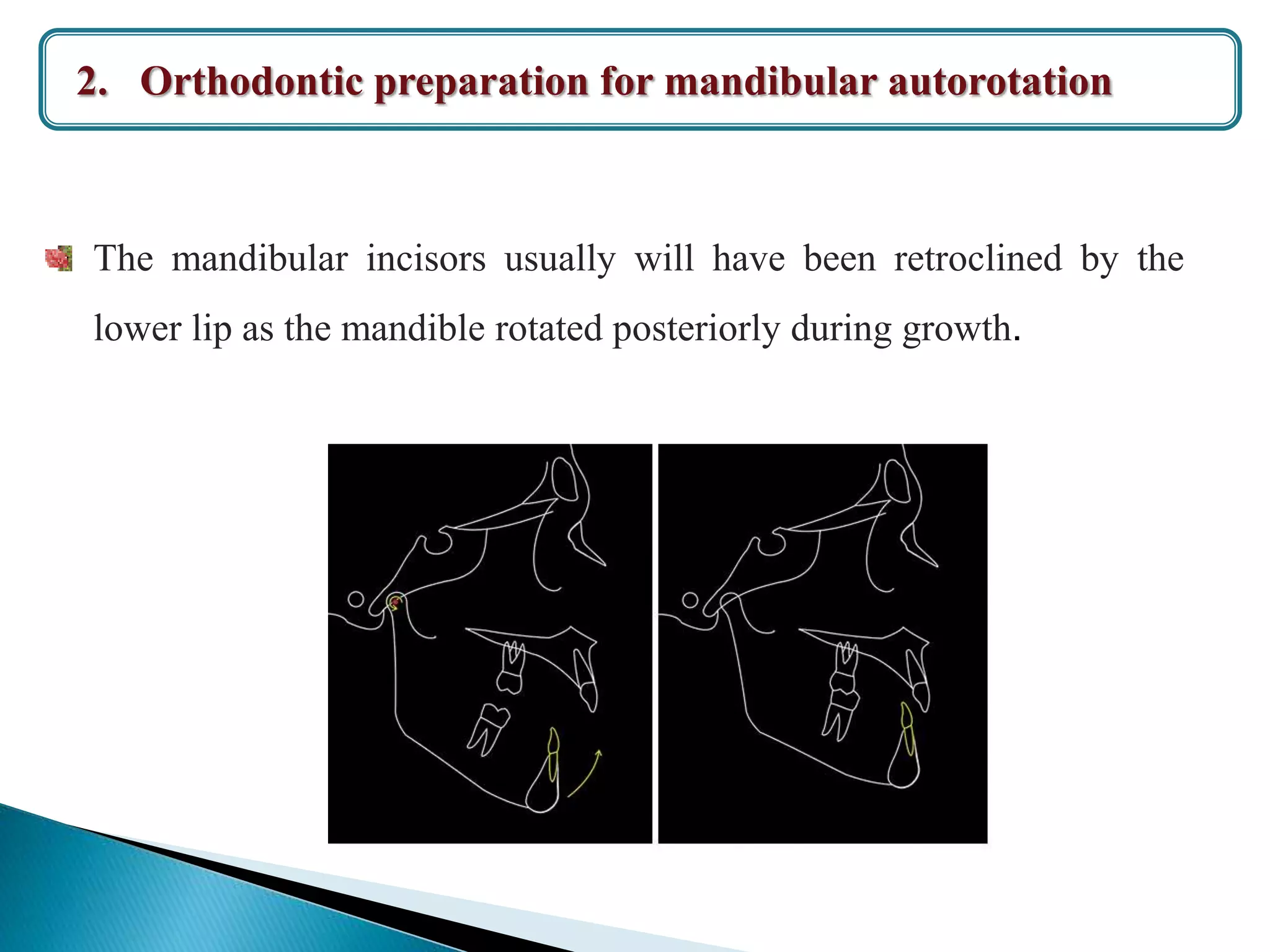 Surgical correction of anterior openbite | PPTX