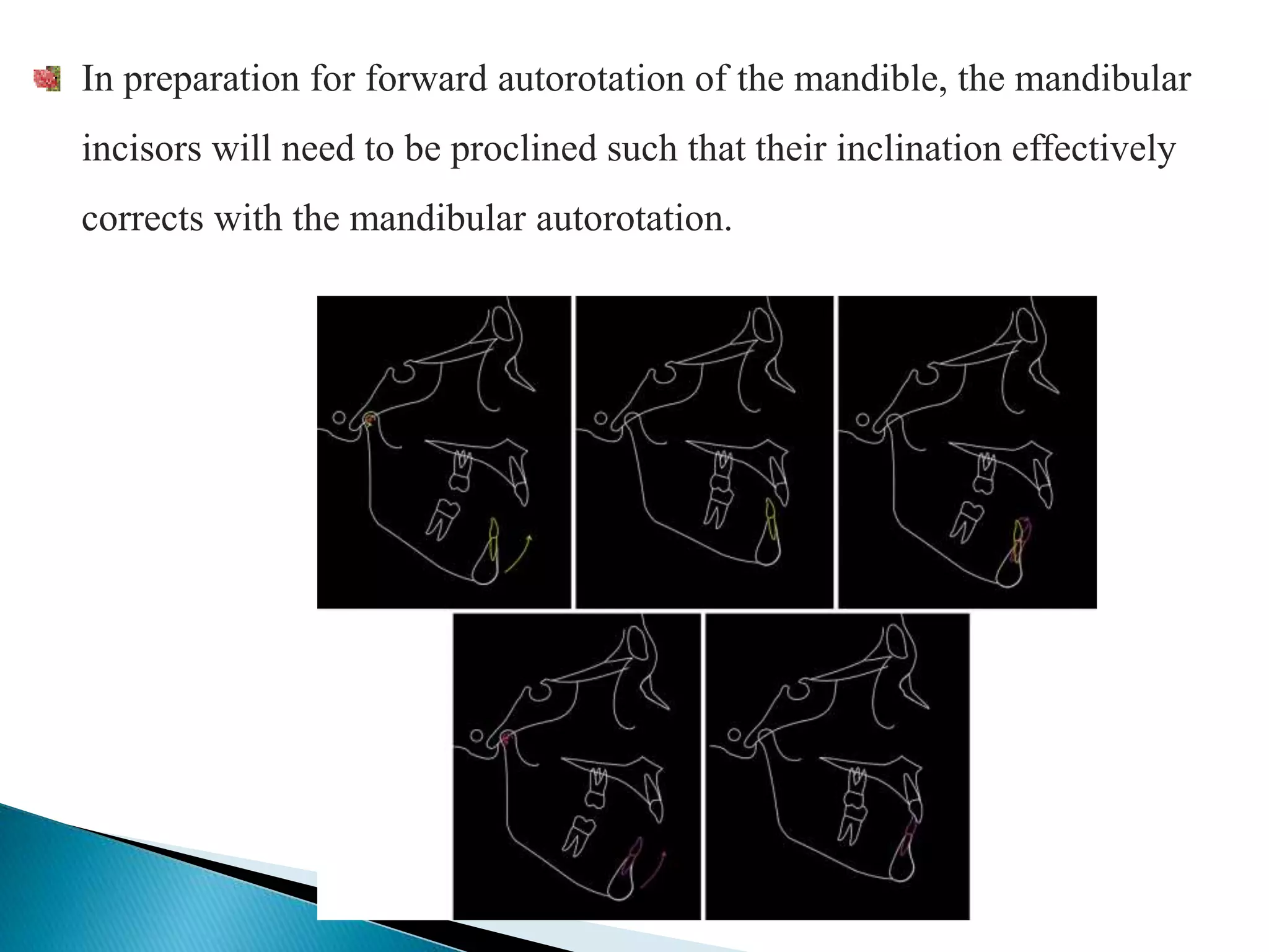 Surgical correction of anterior openbite | PPTX