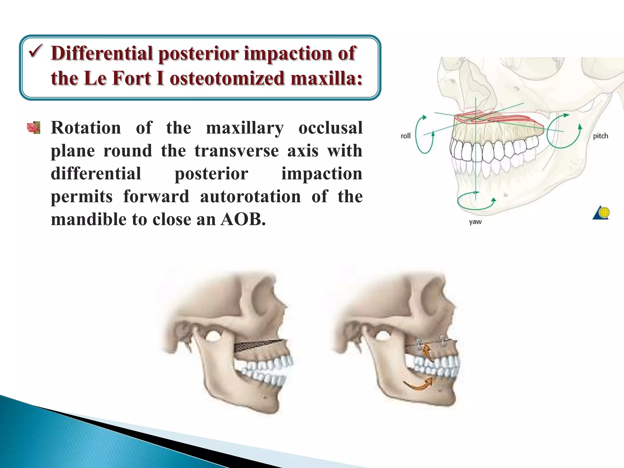 Surgical correction of anterior openbite | PPTX