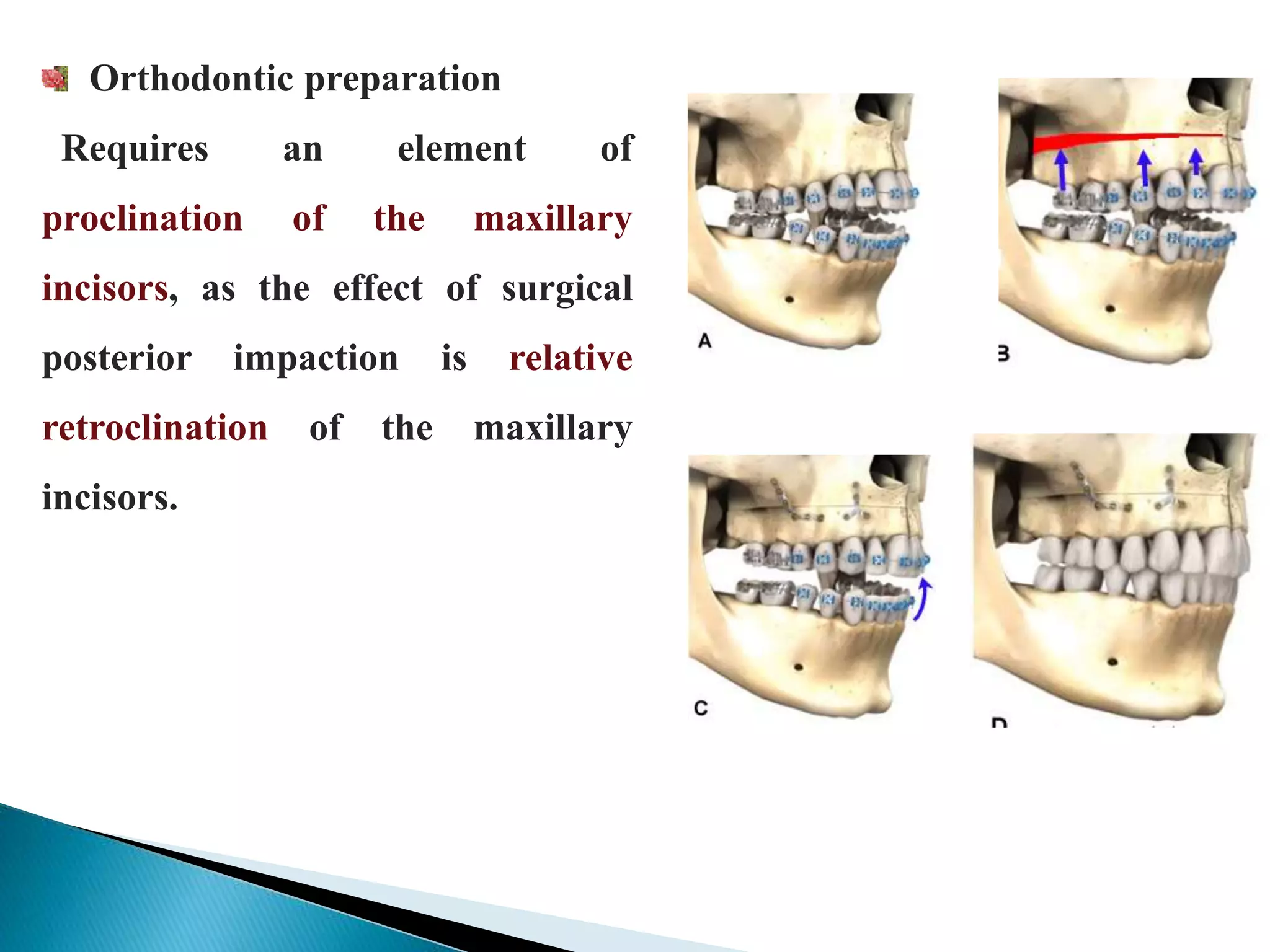 Surgical correction of anterior openbite | PPTX