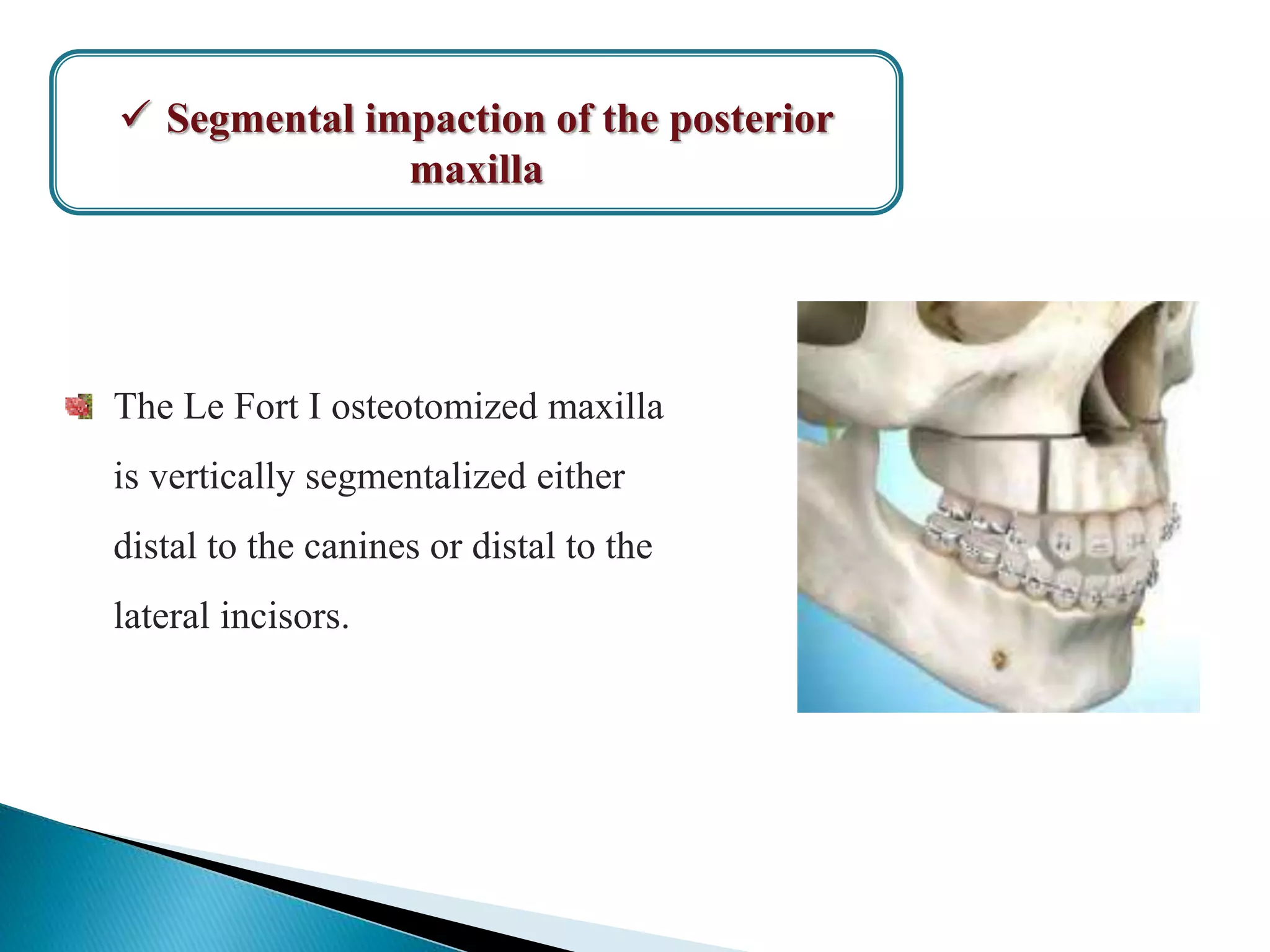 Surgical correction of anterior openbite | PPTX