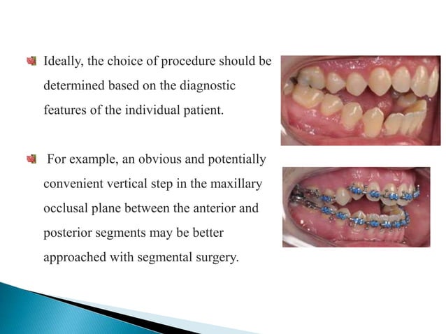 Surgical correction of anterior openbite | PPTX | Bone and Joint ...