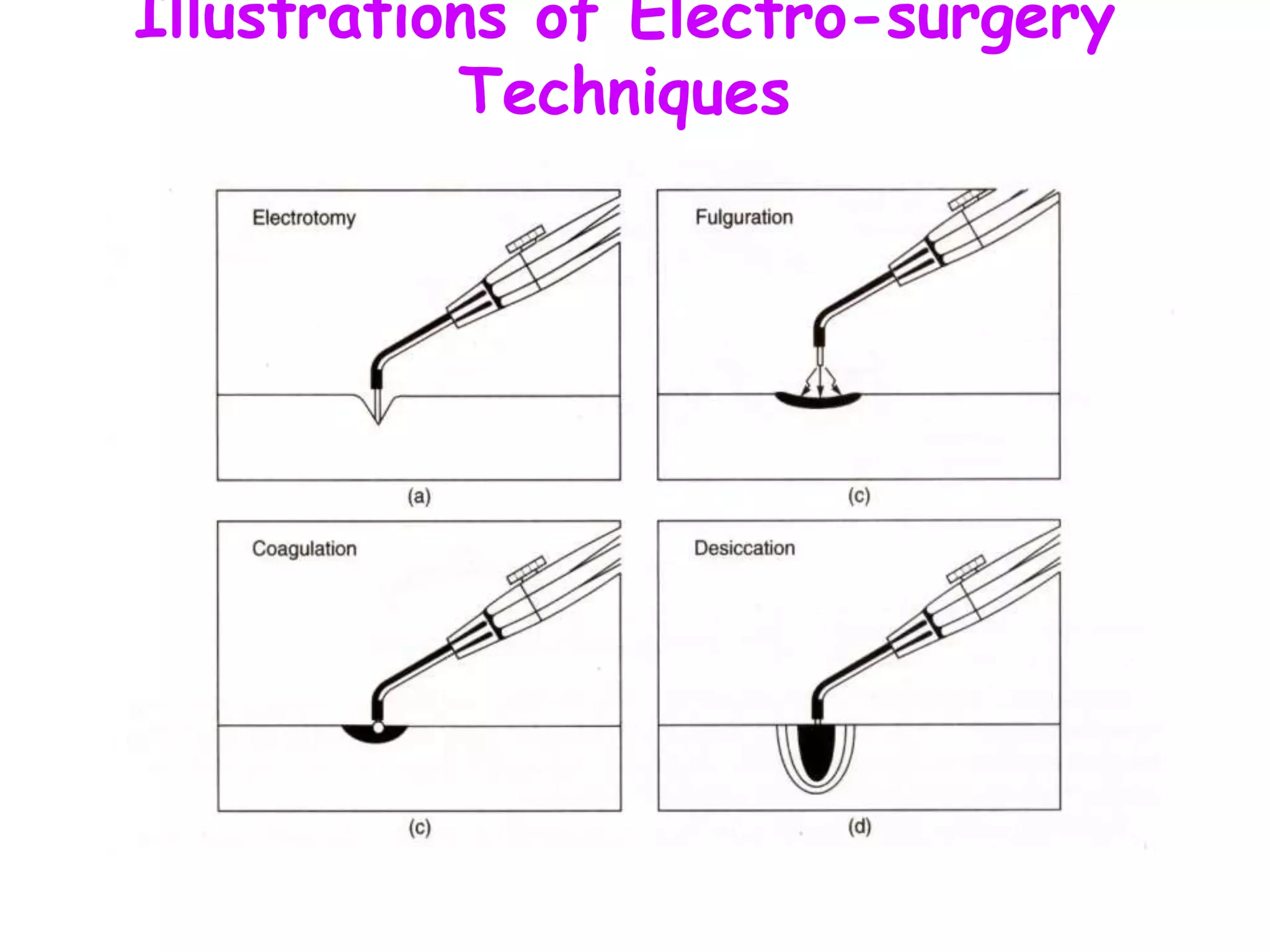 Surgical diathermy | PPTX