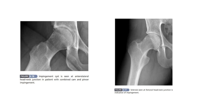 SURGICAL DISLOCATION OF HIP:GANZ APPROACH, KOCHER LANGENBACK,GIBSON ...