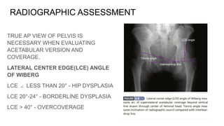 SURGICAL DISLOCATION OF HIP:GANZ APPROACH, KOCHER LANGENBACK,GIBSON ...