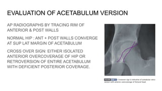 SURGICAL DISLOCATION OF HIP:GANZ APPROACH, KOCHER LANGENBACK,GIBSON ...