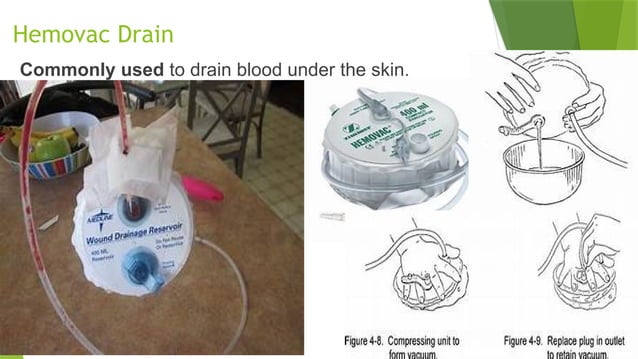 SURGICAL DRAINS & ITS MANAGEMENT.pptx