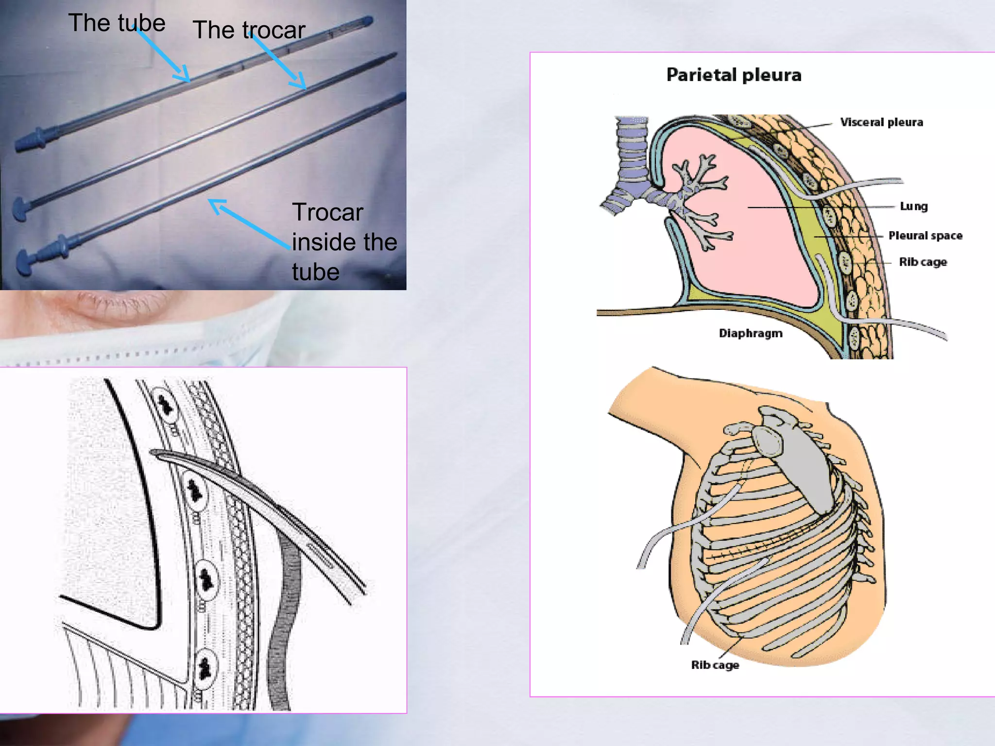 Surgical drains, tube, catheters and central lines | PPT