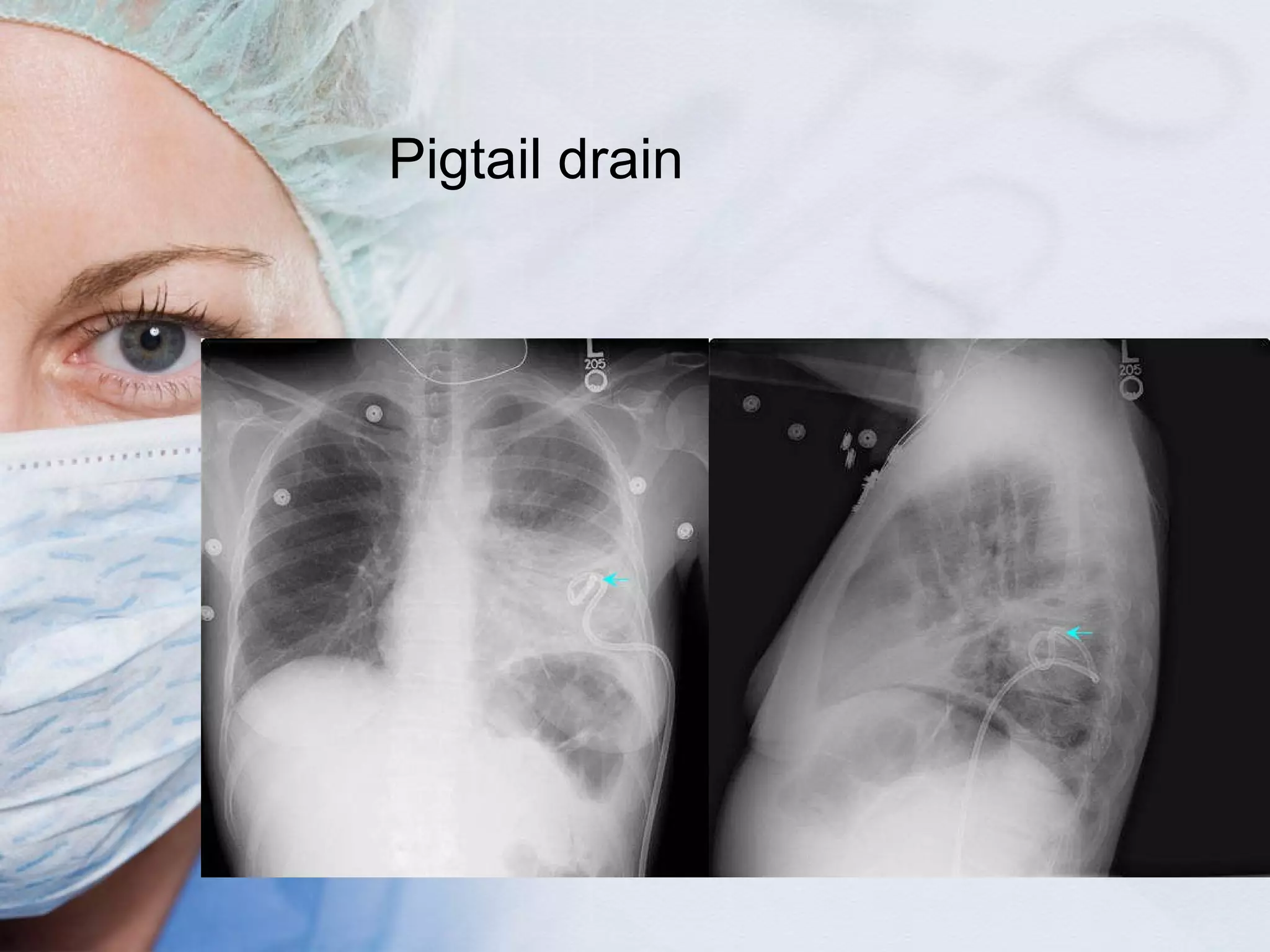 Surgical drains, tube, catheters and central lines | PPT
