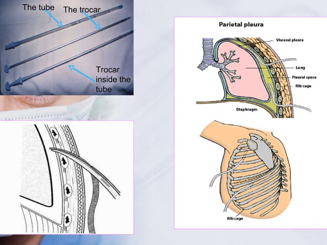 Surgical drains, tube, catheters and central lines | PPT