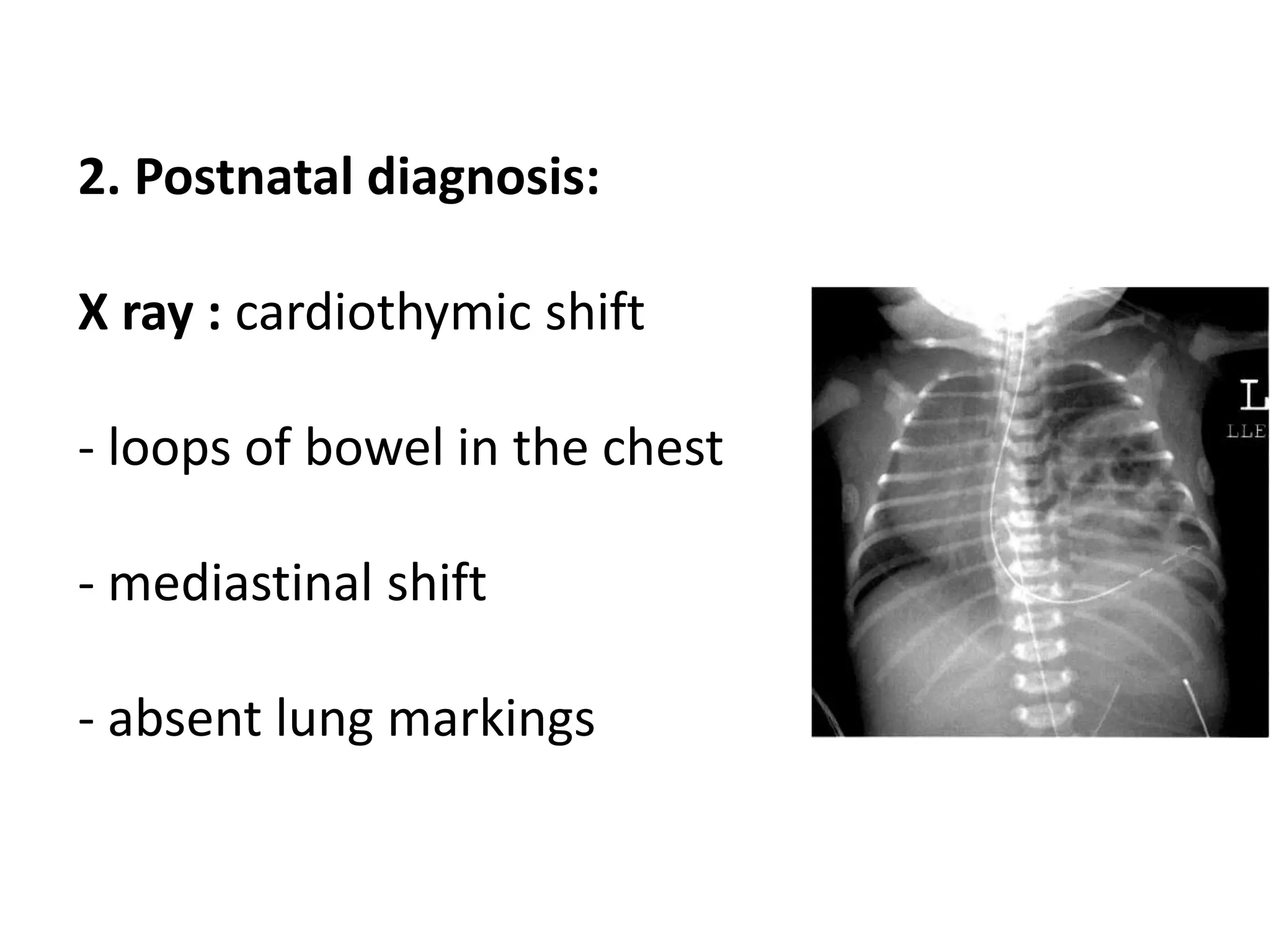 Surgical emergencies in newborn | PPTX