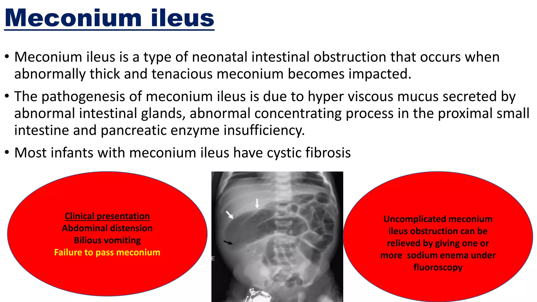Surgical emergencies in the newborn | PPTX
