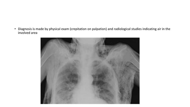 Surgical emphsema | PPTX