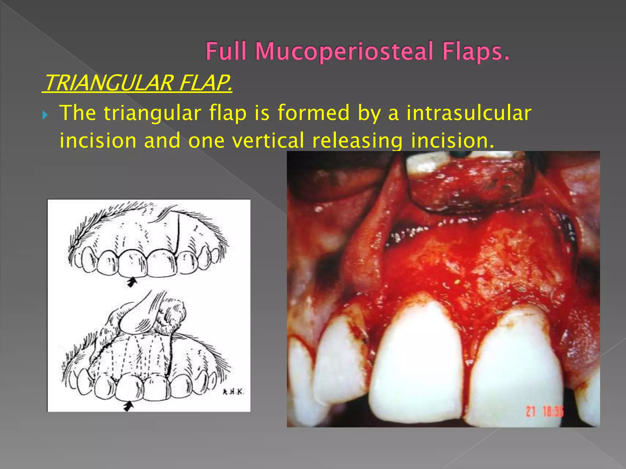 endodontic surgery and its current concepts | PPTX