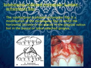 Surgical endodontics (Apicectomy) by Dr. Amit T. Suryawanshi, Oral ...
