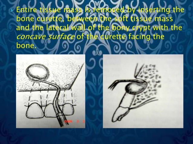 Surgical endodontics(Apicectomy) by Dr. Amit Suryawanshi .Oral ...