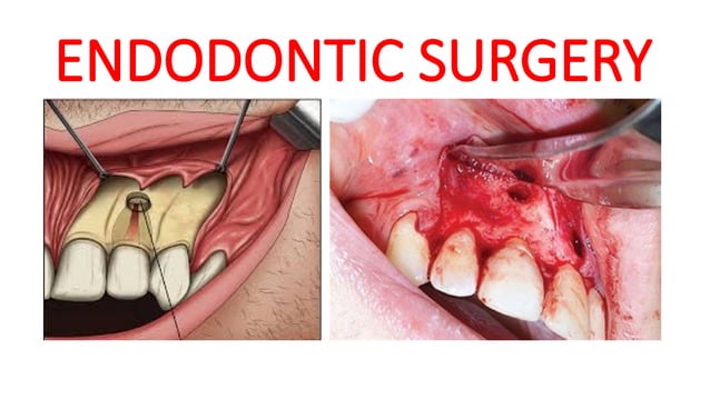 ppt on endodontic surgical procedures.pptx