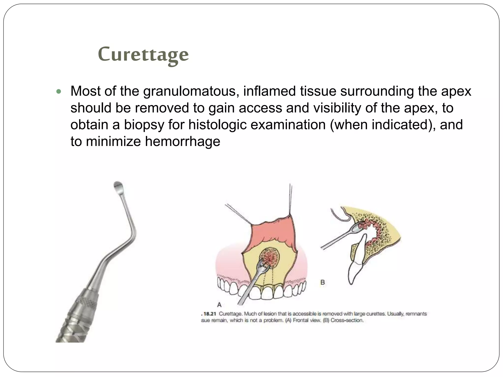 Surgical Endodontics | PPTX