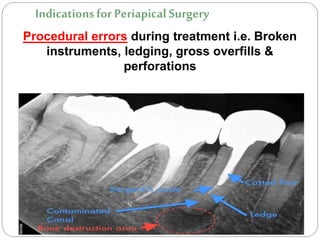 Surgical Endodontics | PPTX