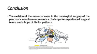 Surgical excision of mesopancreas in pancreatic cancer – is it ...
