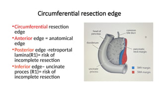 Surgical excision of mesopancreas in pancreatic cancer – is it ...