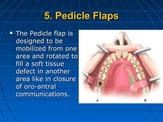 Surgical exodontia | PPT