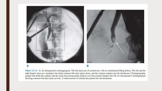 SURGICAL EXPLORATION OF THE COMMON BILE DUCT.pptx