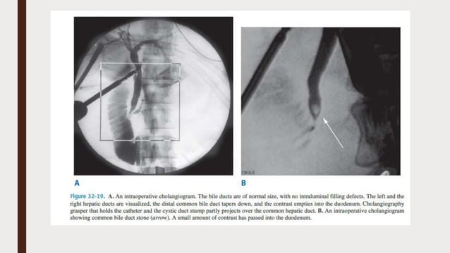 SURGICAL EXPLORATION OF THE COMMON BILE DUCT.pptx | Digestive Disorders ...