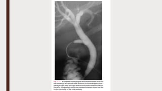 SURGICAL EXPLORATION OF THE COMMON BILE DUCT.pptx
