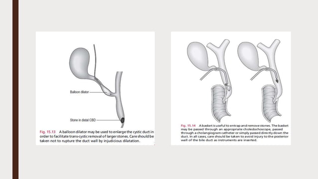 SURGICAL EXPLORATION OF THE COMMON BILE DUCT.pptx | Digestive Disorders ...