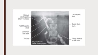 SURGICAL EXPLORATION OF THE COMMON BILE DUCT.pptx