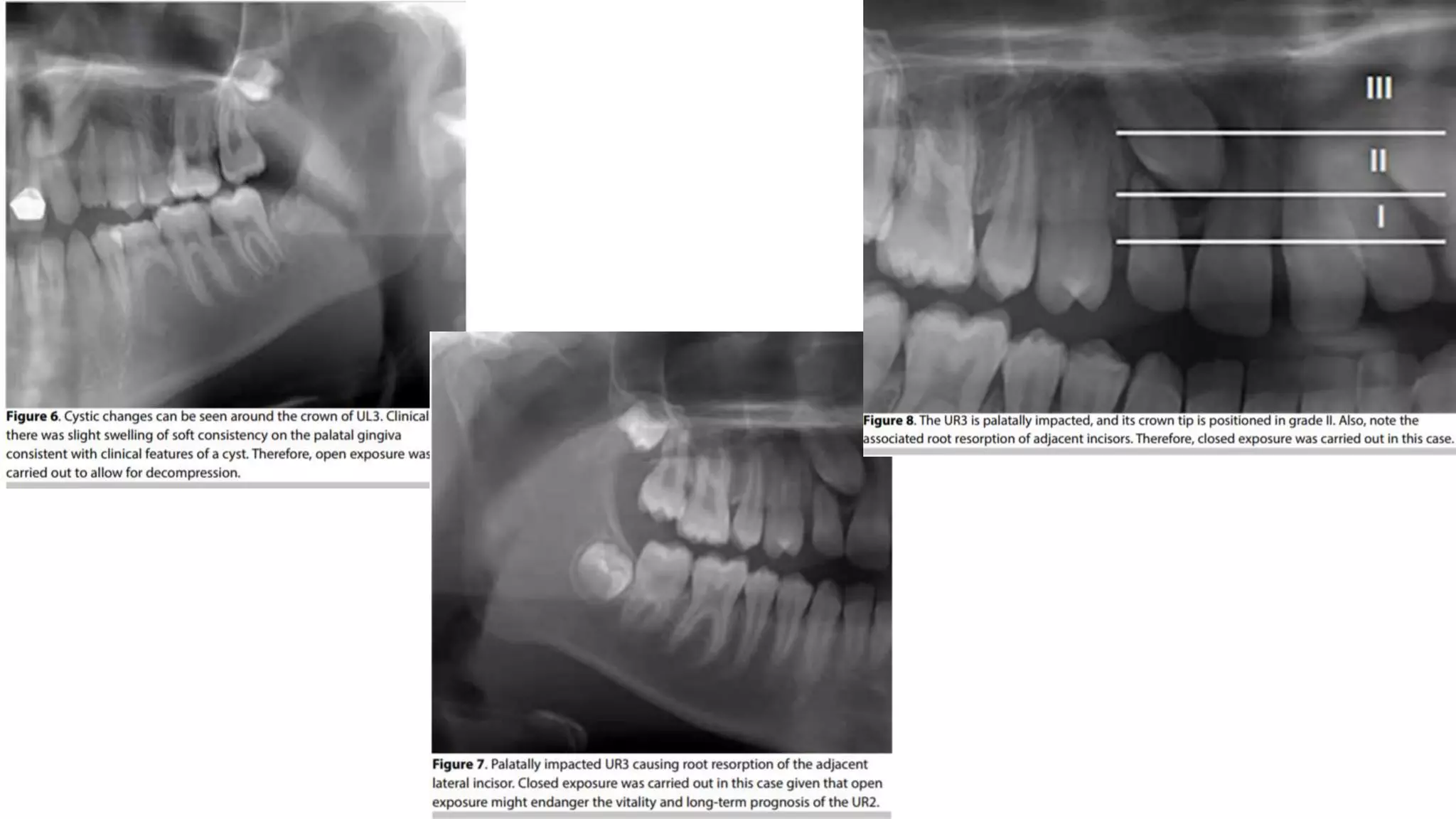 Surgical exposure of palatal canines | PPTX
