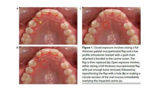 Surgical exposure of palatal canines | PPTX