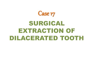 Surgical extraction dilacerated tooth | PPTX