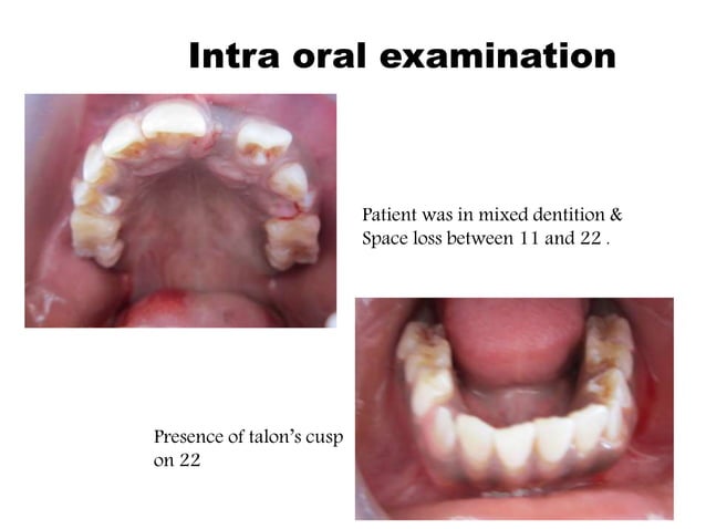 Surgical extraction dilacerated tooth | PPT
